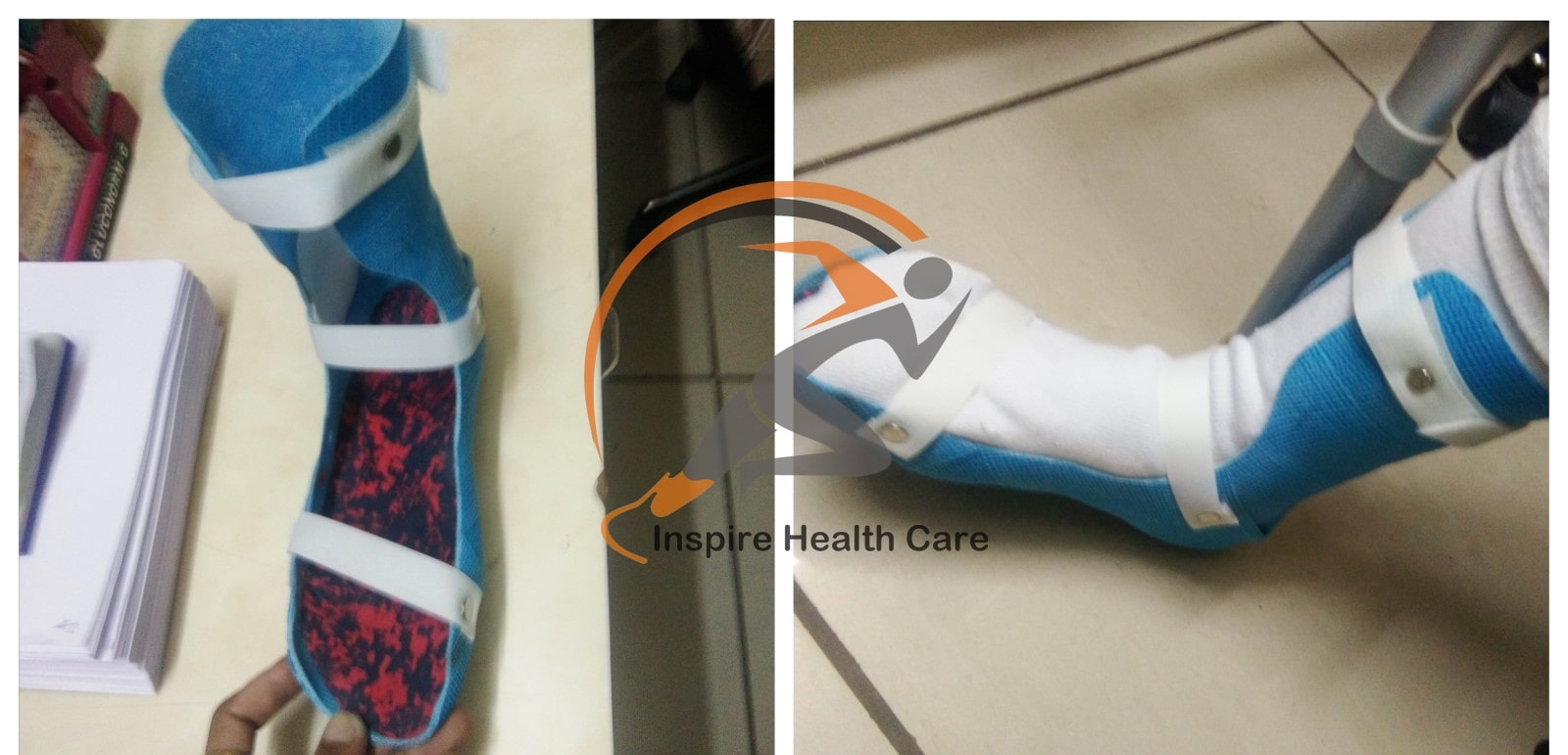 Inspire Structure | Low Temperature Thermo Plastic Splinting