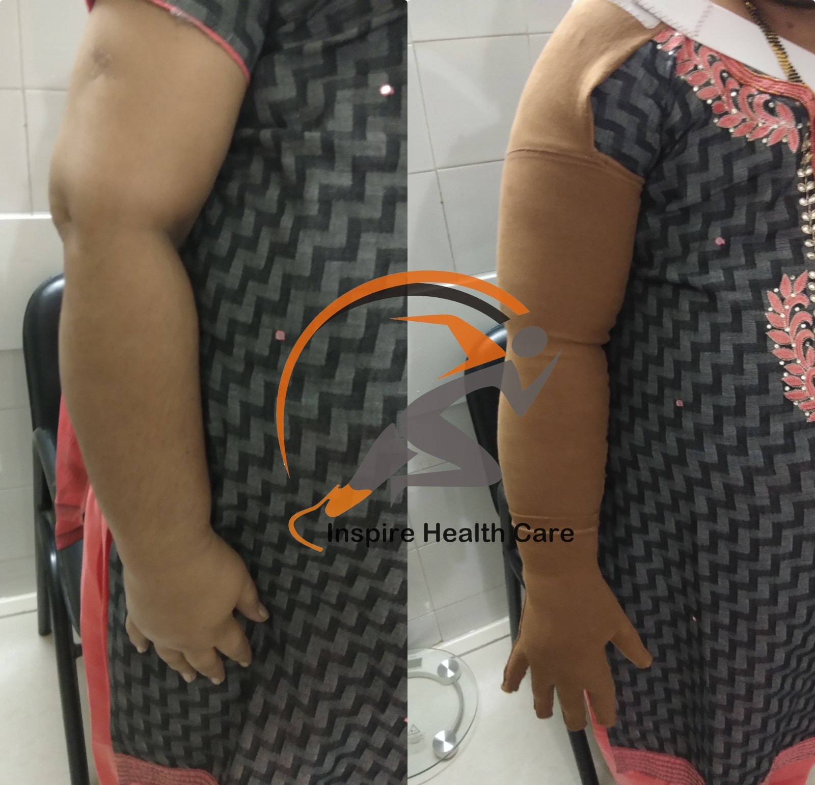 Inspire Structure | Pressure Garments and Silicone Gel Care Sheet