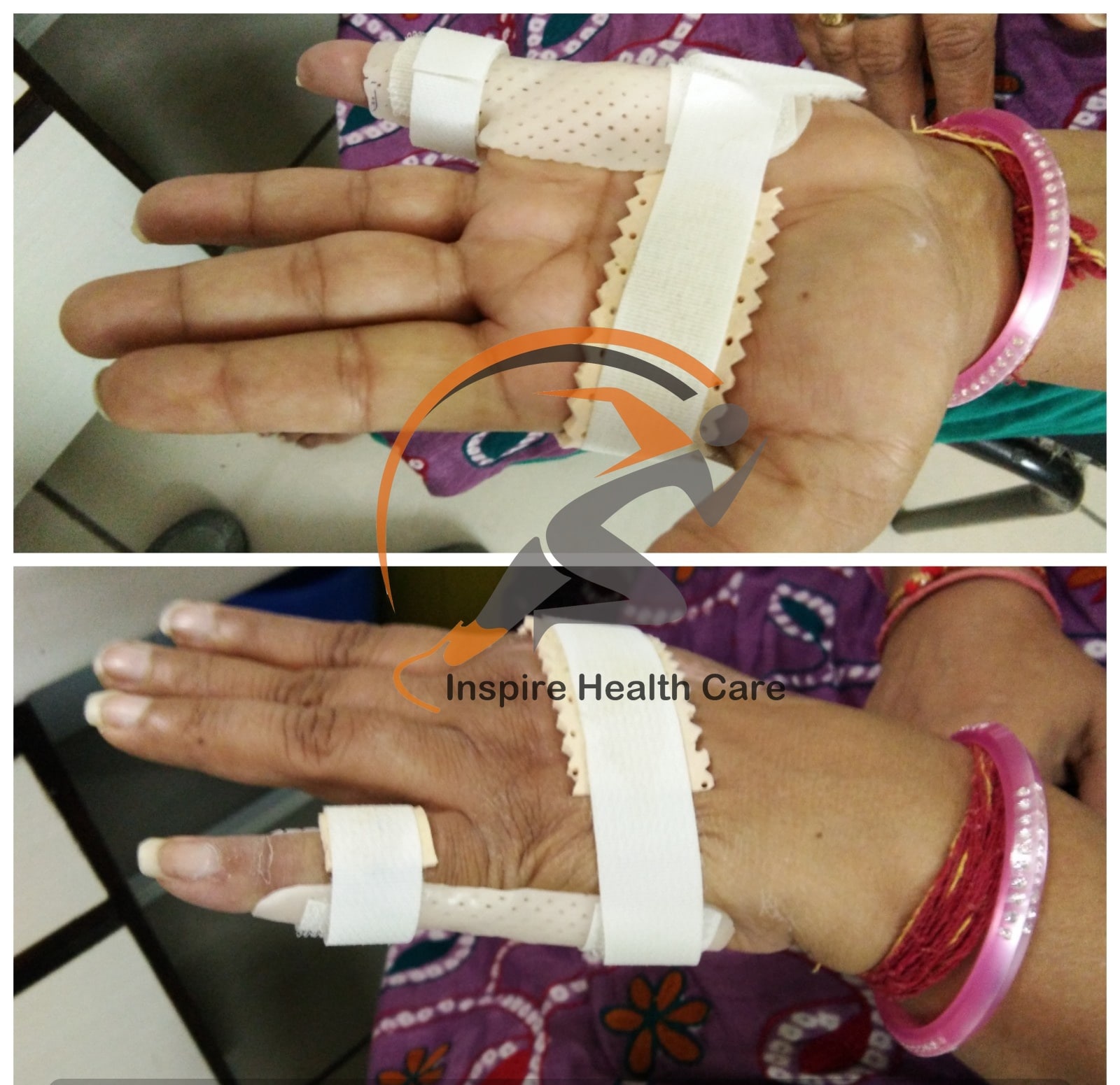 Inspire Structure | Low Temperature Thermo Plastic Splinting