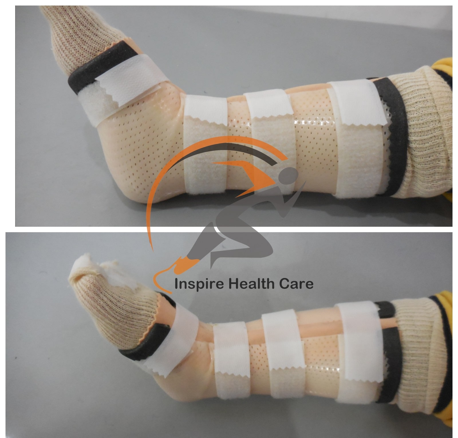 Inspire Structure | Low Temperature Thermo Plastic Splinting