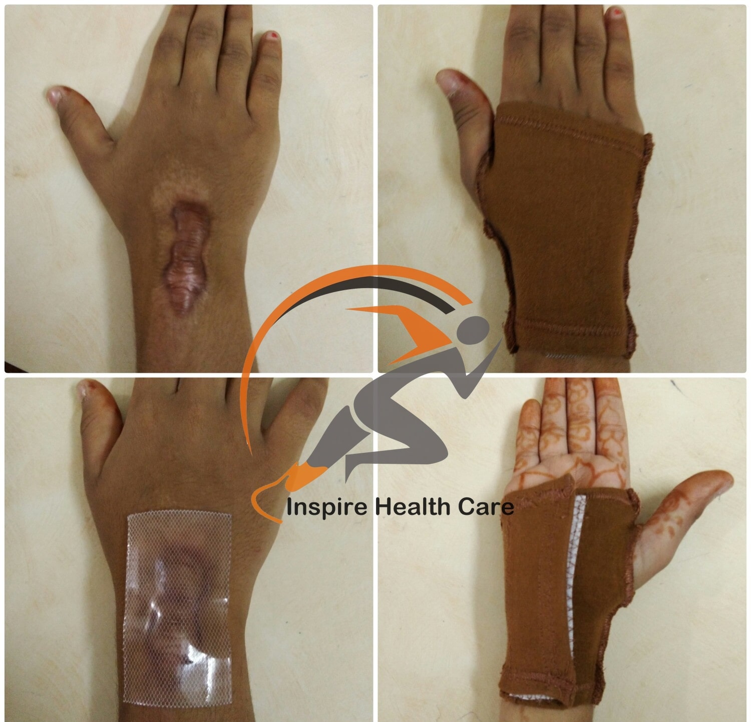 Inspire Structure | Pressure Garments and Silicone Gel Care Sheet